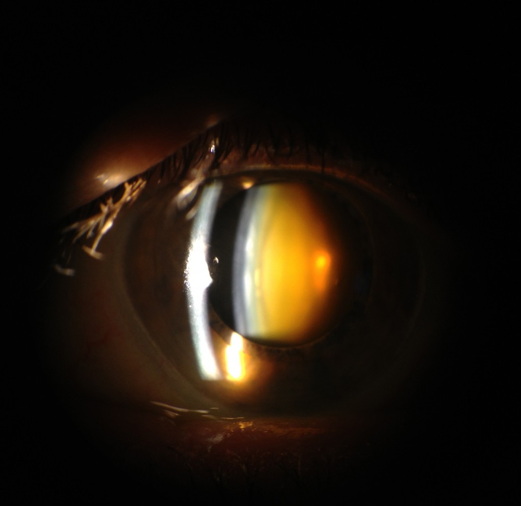 Cataracts – St. Louis Eye Institute